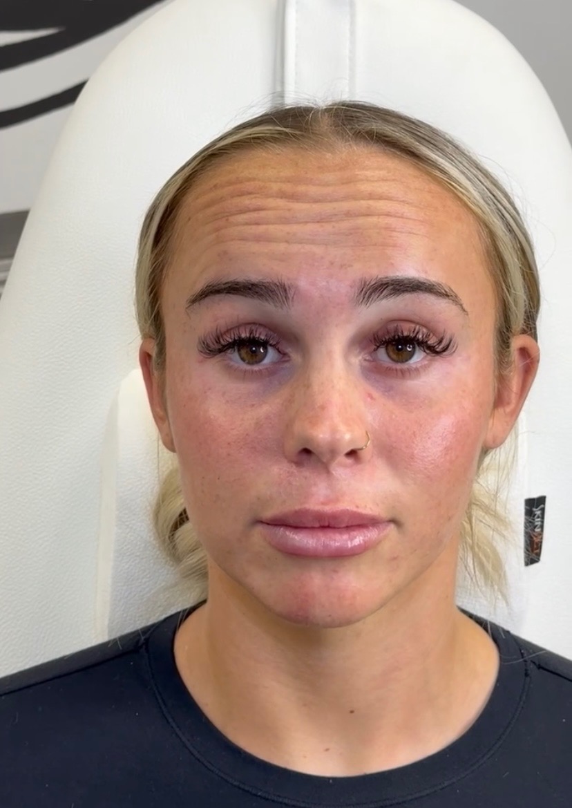 Botox Treatment - Before